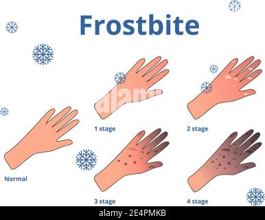 Frostbite stages. Frozen hands with fingers. Hypothermia Stock Vector ...