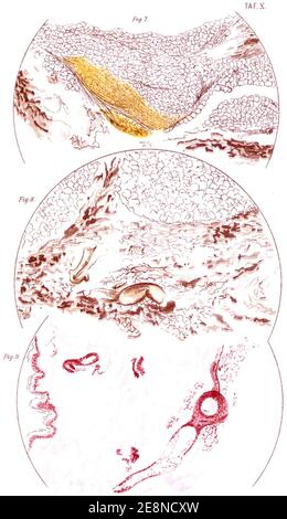 Morbus Fabry Emil Honke 1898 04 Stock Photo - Alamy