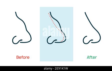 Rhinoplasty nose plastic surgey icon. Vector rhinoplasty beauty icon ...
