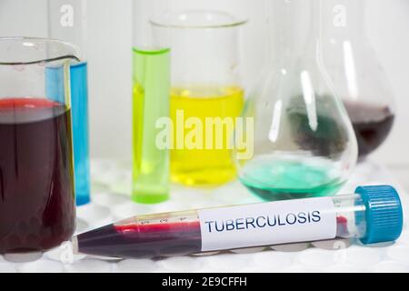 Tuberculosis. Tuberculosis disease blood test in doctor hand Stock ...