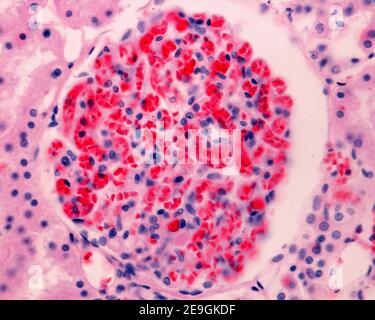 Light micrograph of a human kidney affected by an advanced diabetic ...