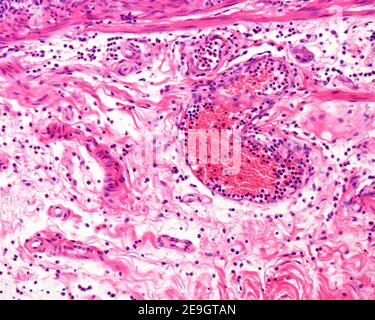 Inflamed connective tissue, light micrograph Stock Photo - Alamy