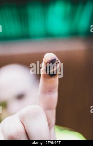 Smashed finger accidents on blurry background Stock Photo - Alamy