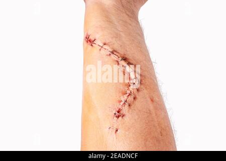 Surgery wound fix with staple on arm,isolated on white background Stock ...