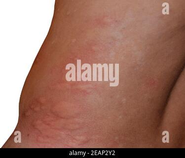 Allergy skin back and sides. Allergic reactions on the skin in the form ...