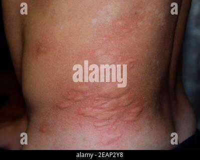 Allergy skin back and sides. Allergic reactions on the skin in the form ...