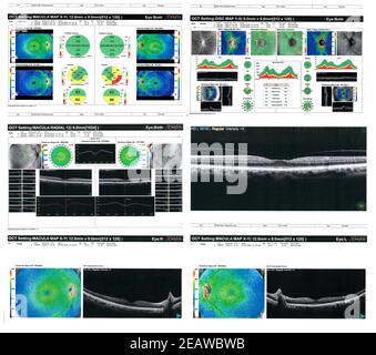 Macular degeneration. Optical coherence tomography (OCT) scan of a ...