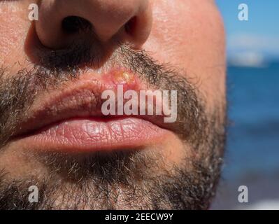 Sunburn on man lips closeup. Sun burn or bacterial infection on skin ...