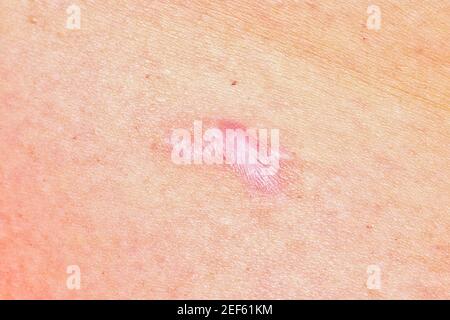 Scar on human skin scar or cicatrice after operation on stomach Stock ...