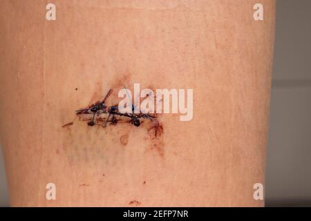 stitched up injury Stock Photo - Alamy