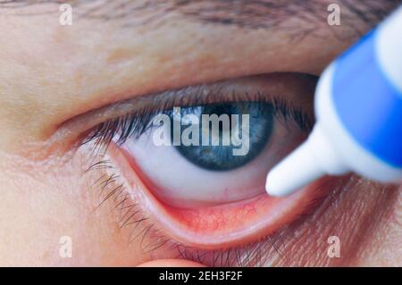 Implementation drug in conjunctival sac. Instill eye ointment Stock ...