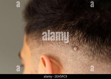Laser removal of a mole on man neck in beauty salon Stock Photo - Alamy