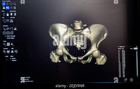 3D reconstruction from a CT image of a patient's pelvis for ...