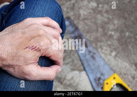 Closeup of fresh wound on man's knee from accident Stock Photo - Alamy