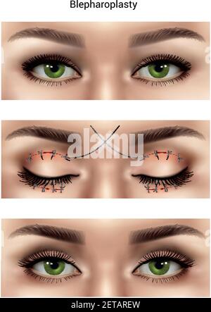 Surgical suture stitches realistic set of images on transparent ...