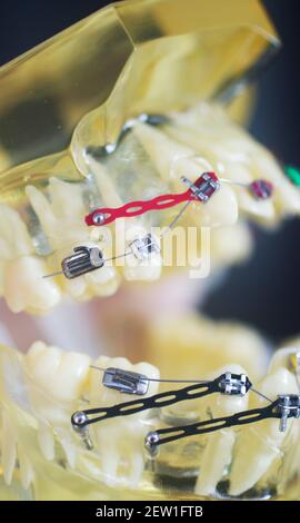 Dental teeth aligner bracket teaching student model showing gums and ...