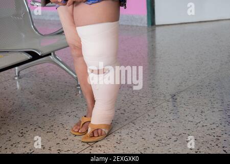 filariasis patient abnormal lymphatic function patient Stock Photo - Alamy