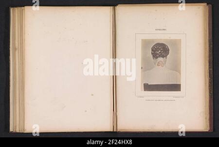 Woman with skin rashes caused by syphilis; Syphilide tuberculeuse Stock ...