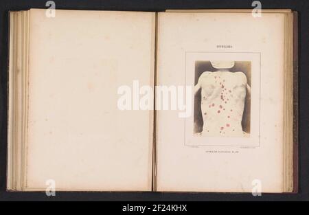 Skin rash caused by syphilis; Syphilide papuleuse lenticular Stock ...
