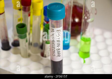 Mononucleosis and Epstein-barr virus blood test sample in lab on the ...