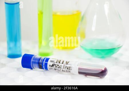Closeup shot of HIV positive blood specimen on a test tube in the ...