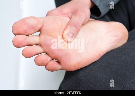 Foot wart, verrucas plantar on the foot of a child. A decease caused by ...