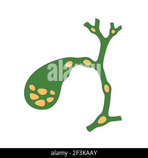 Variants of the location of stones in the gallbladder and bile ducts ...