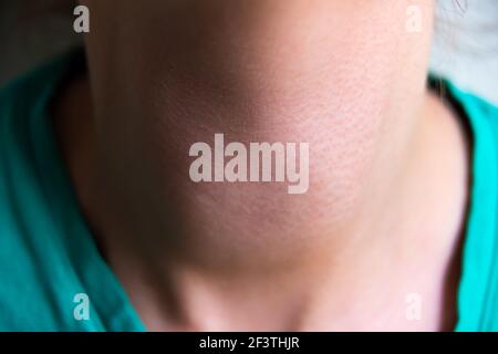Woman with goiter Stock Photo - Alamy
