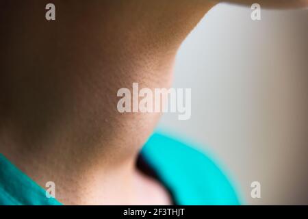 Thyroiditis (Hashimoto's disease). Patient with an enlarged thyroid ...