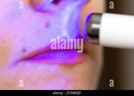 Close-up of the red and inflamed nose of a 38 year old female patient ...