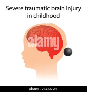 Traumatic brain injury in childhood, illustration Stock Photo - Alamy