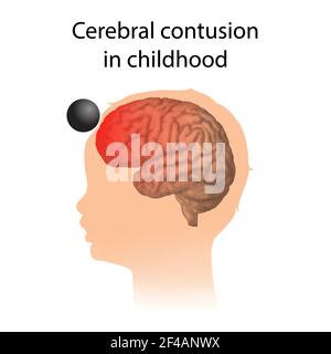 Cerebral contusion, illustration Stock Photo - Alamy