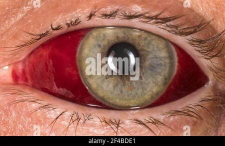 Human eye with subconjuctival hemorrhage, broken blood vessel, extreme ...