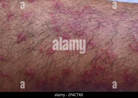 A closeup of post-vaccination rashes on the skin Stock Photo - Alamy