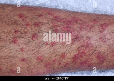 A closeup of post-vaccination rashes on the skin Stock Photo - Alamy