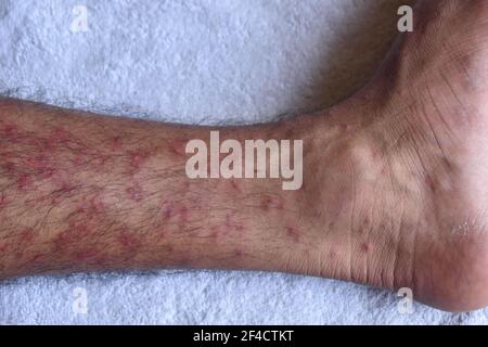 A closeup of post-vaccination rashes on the skin Stock Photo - Alamy