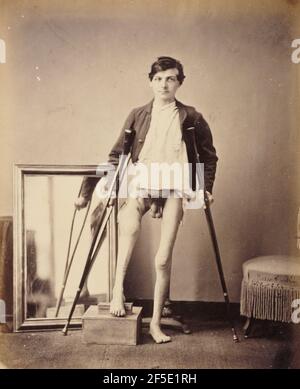 Gunshot Fracture of the Shaft of the Right Femur, United with Great ...