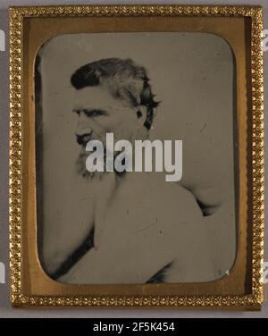 Portrait of a Bearded Man with Abnormal Hump Growth on Back. Unknown ...