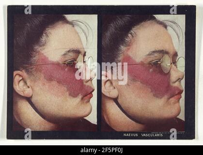 Naevus Vascularis. Dr. Selden I. Rainforth (American, 1879 - 1960 Stock ...