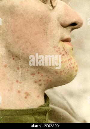Dermatitis from Mustard Gas, First World War Stock Photo - Alamy