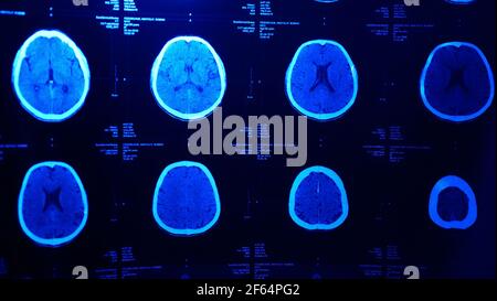 This stock photo shows a magnetic resonance imaging MRI of the brain ...