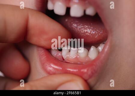 close-up of the roots of the baby tooth sticking out from the gum, the ...