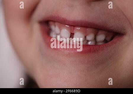 Loosing a Tooth a Stock Photo - Alamy