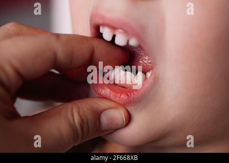 close-up of the roots of the baby tooth sticking out from the gum, the ...