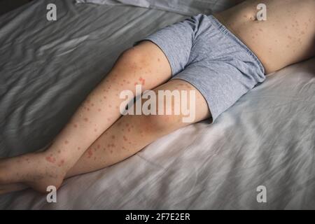 Child with skin rash, roseola, Hand-foot-and-mouth disease, child rash ...