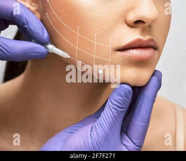 Thread facelift, concept of lifting skin. Procedure facial contouring ...