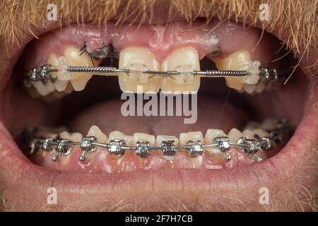 Two dental implants on upper jaw and metal braces on both rows of teeth ...