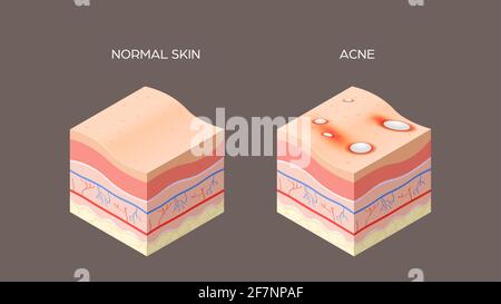 Acne vulgaris or pimple cross-section of human skin layers structure ...