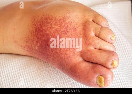 erysipelas of the legs, red rash on the legs.selectivw focus Stock ...