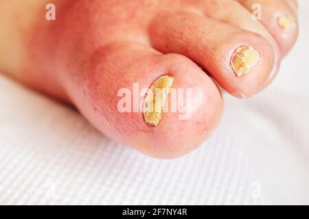 erysipelas of the legs, red rash on the legs.selectivw focus Stock ...